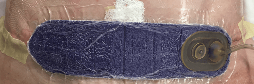 Prevena Dressing: Post-Reconstruction Wound Care